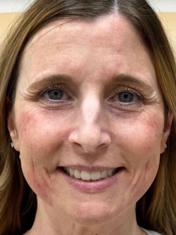 Treatments for Marionette Lines