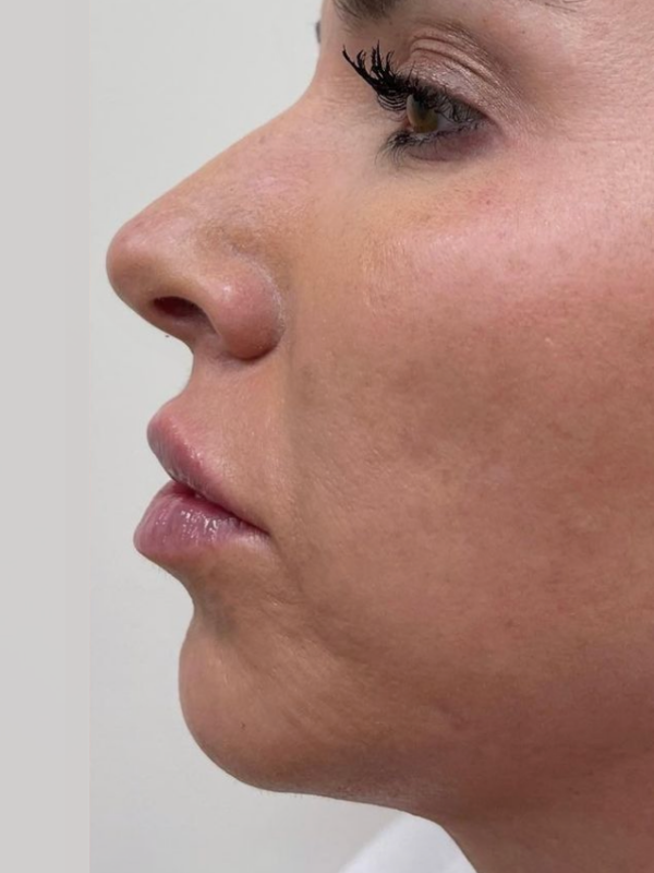 Treatments for Narrow Chin