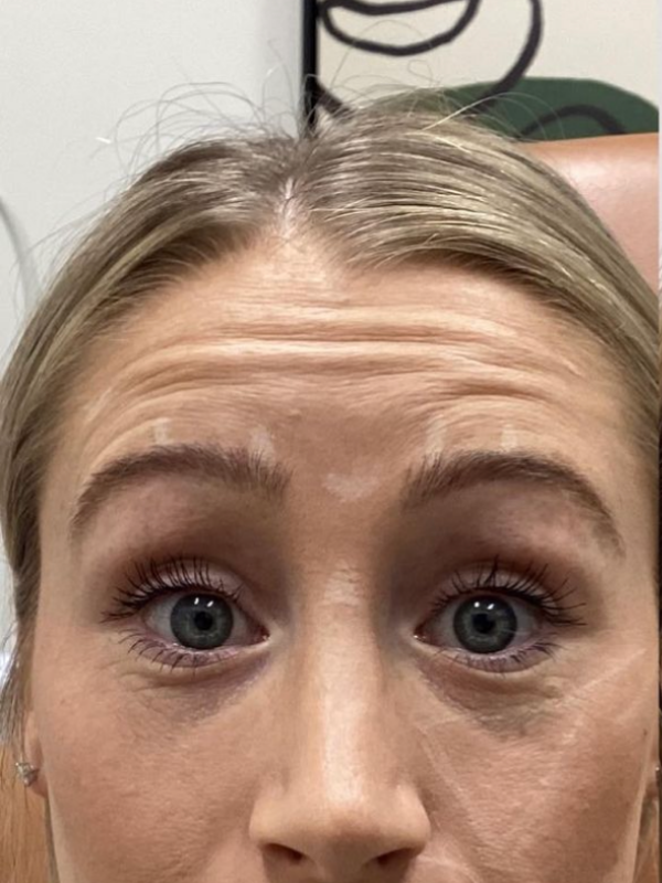 Treatments for Forehead Lines