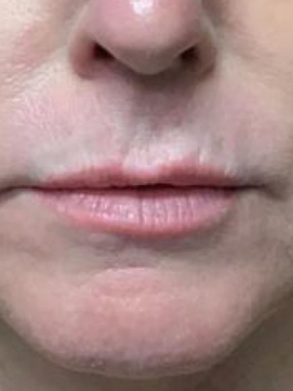 Treatments for Marionette Lines