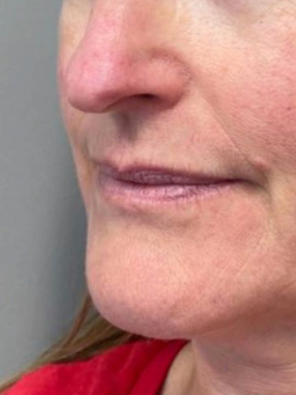 Treatments for Aging Lips