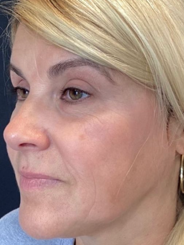 Treatments for Sunken Cheeks