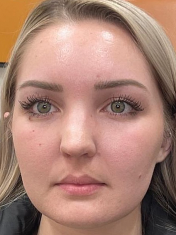 Treatments for Chipmunk Cheeks