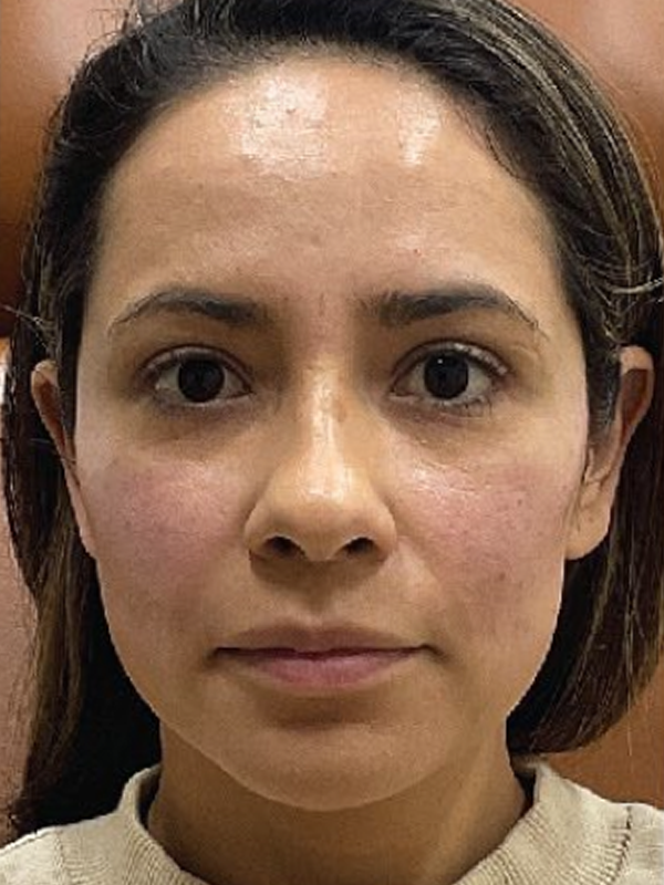 Treatments for Sunken Cheeks