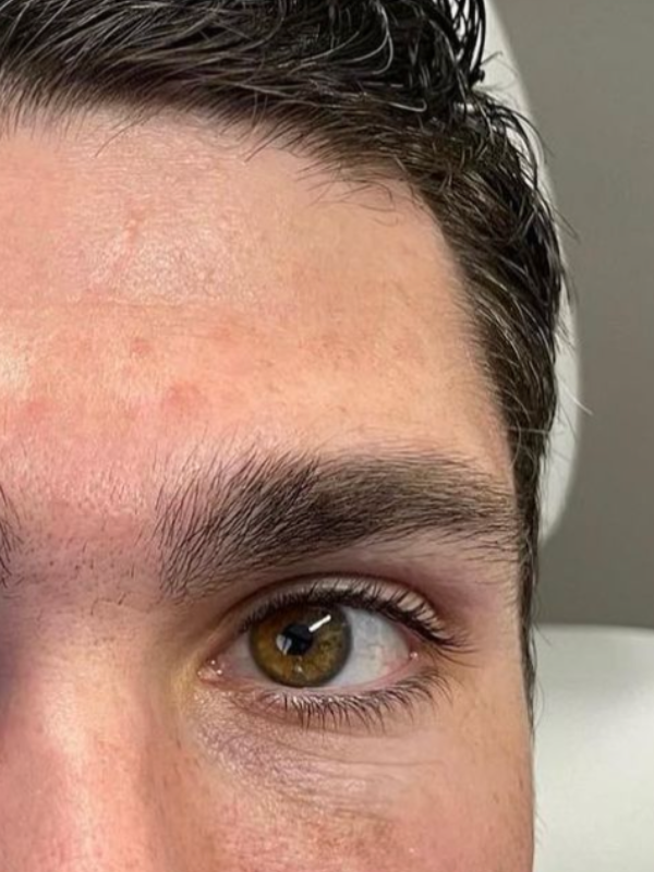 Treatments for Forehead Lines
