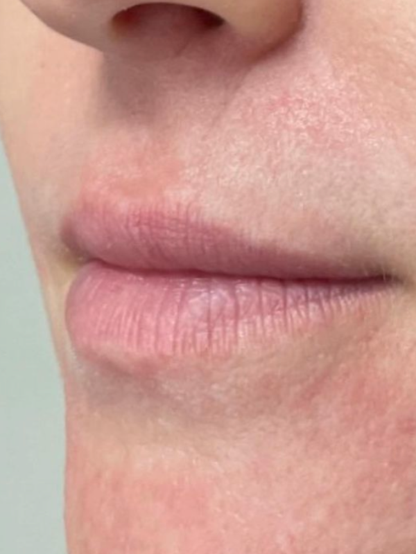 Treatments for Aging Lips