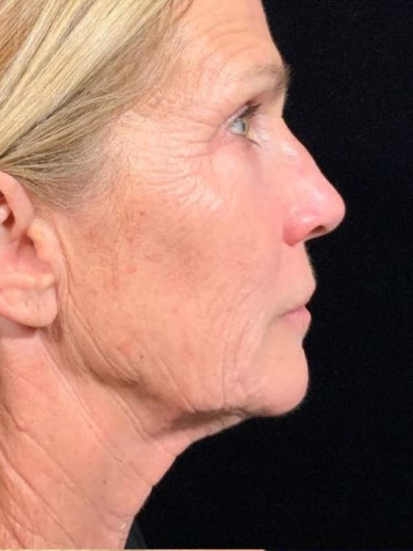 Treatments for weak chin and jawline
