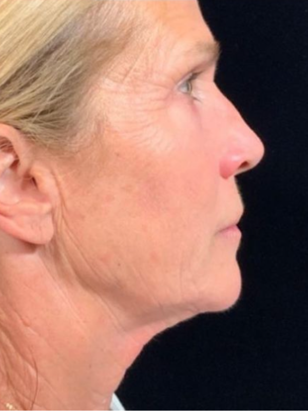 Treatments for weak chin and jawline