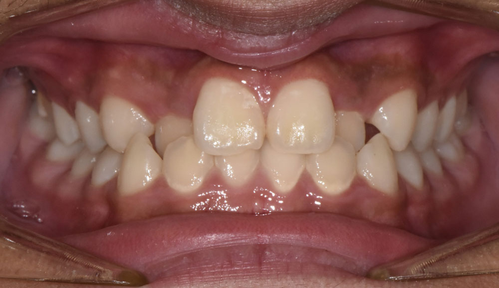 Zental - Invisalign at Zental - Achieve Straighter Teeth Invisibly