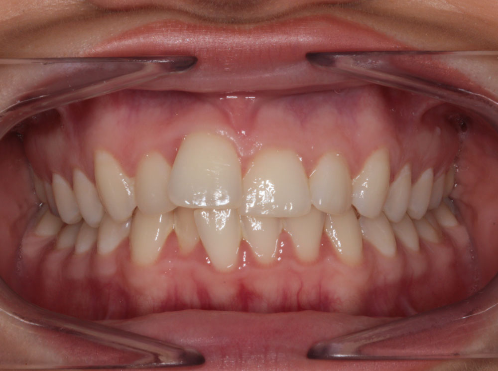 Zental - Invisalign at Zental - Achieve Straighter Teeth Invisibly