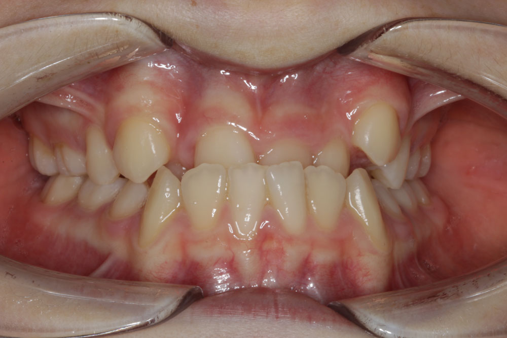 Zental - Straighten Teeth Discreetly with Zental's Ceramic Braces