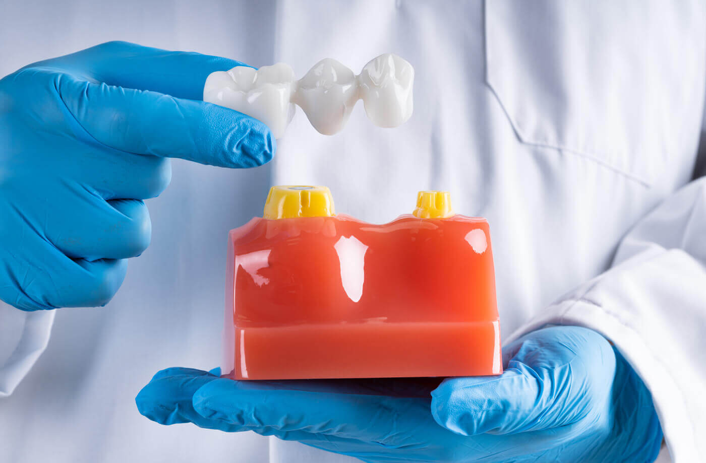 Bridges | Smalltown Dental