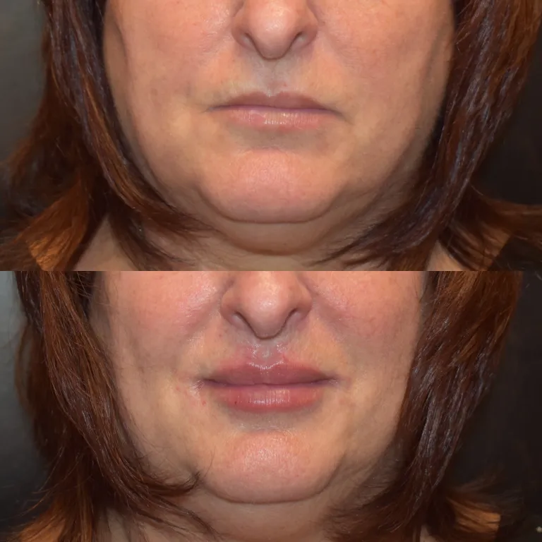 Dermal Fillers | Dermatology Experts | Dermatologist Miami, Parkland ...