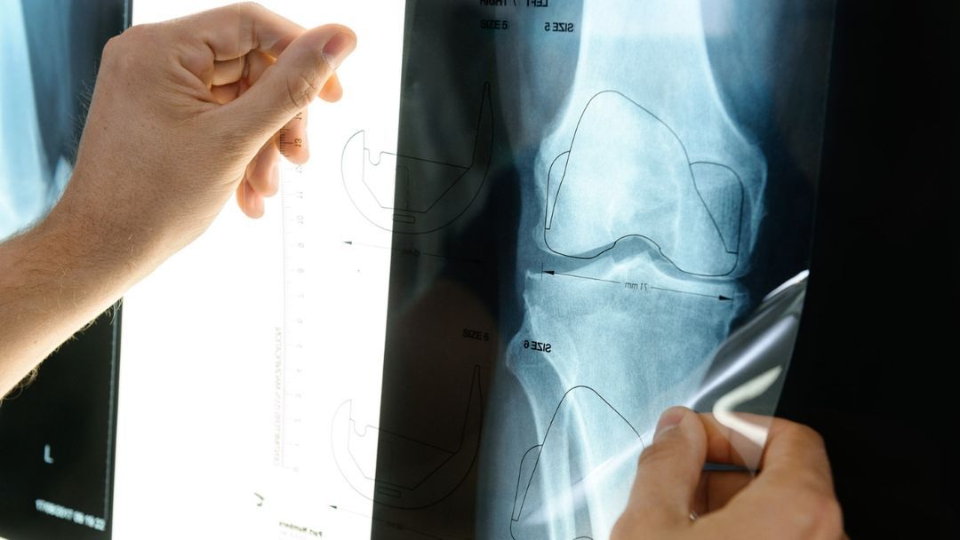 Prehabilitation Before Total Knee Replacement Surgery