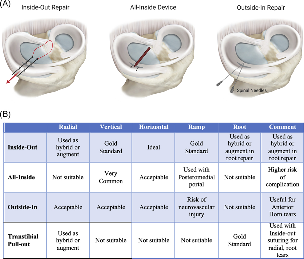Infographic - Meniscus Repair Techniques | MERCuRE