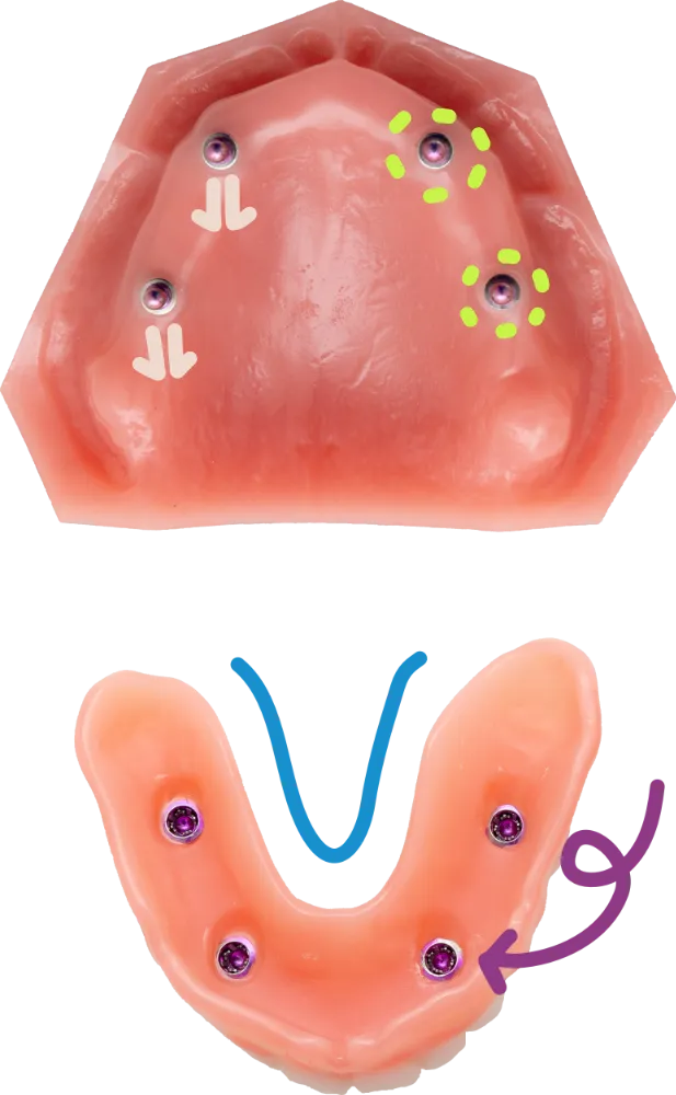 Dentures + Implants: Restore Your Smile, Boost Confidence | Dental Care Now