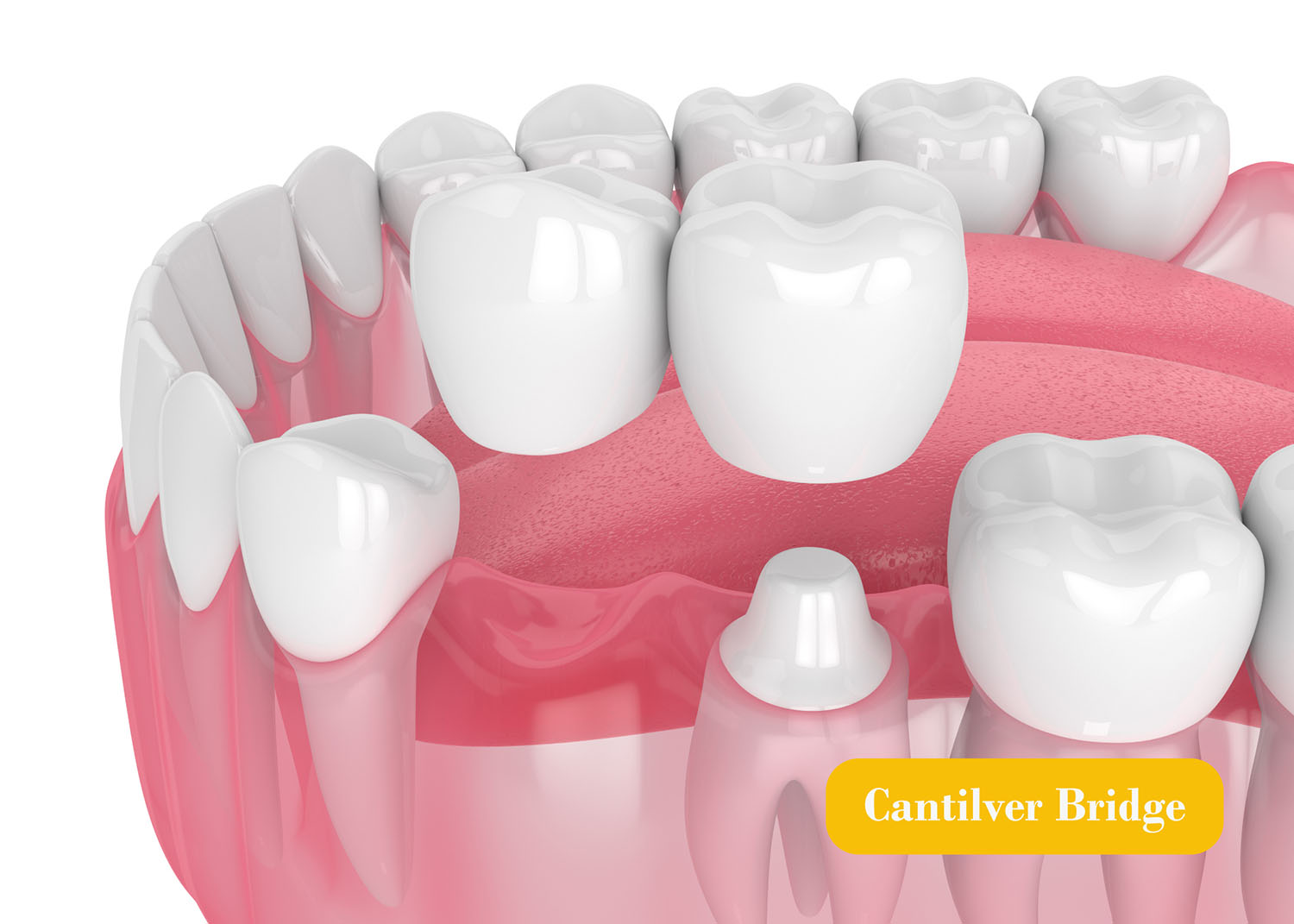 Dental Bridges | Lighthouse Dental Centre | Langley