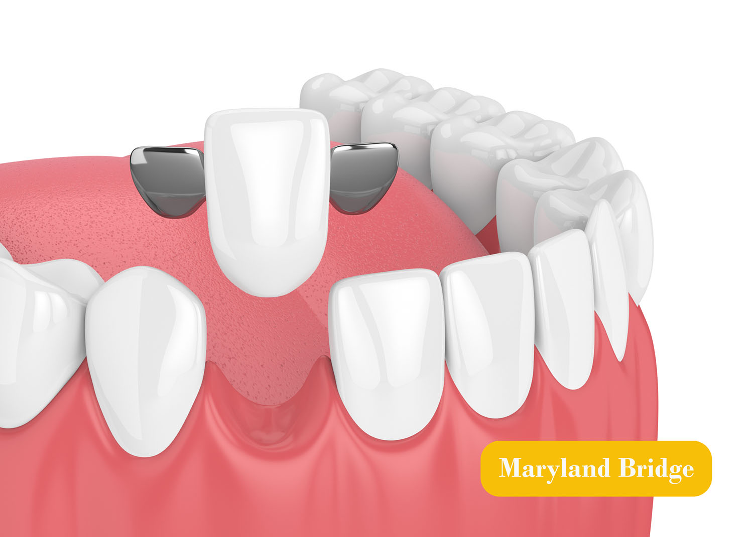 Dental Bridges | Lighthouse Dental Centre | Langley