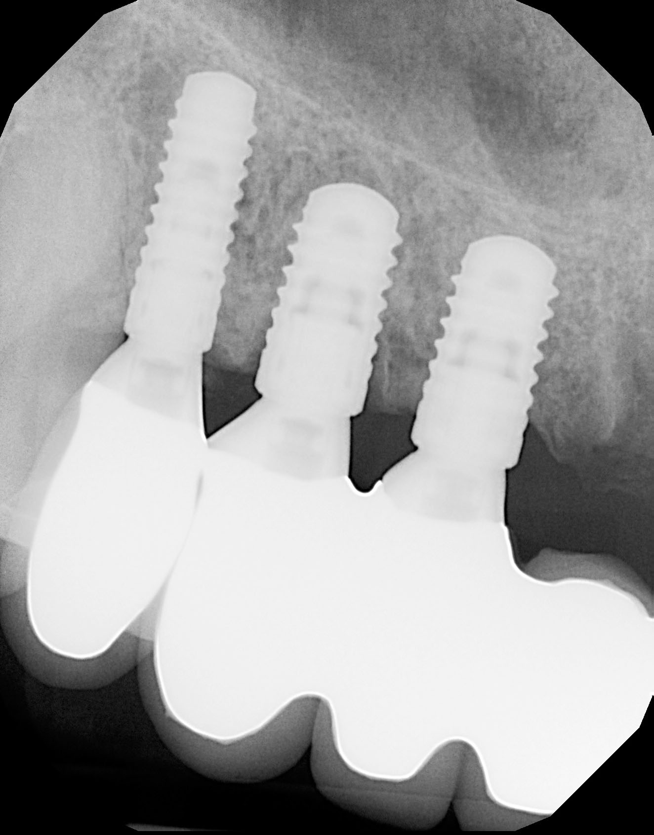 Dental Implants Cost: What to Expect
