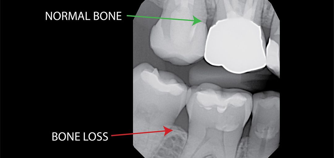 Can you Still Have Dental Implants if You Have Severe Bone Loss?