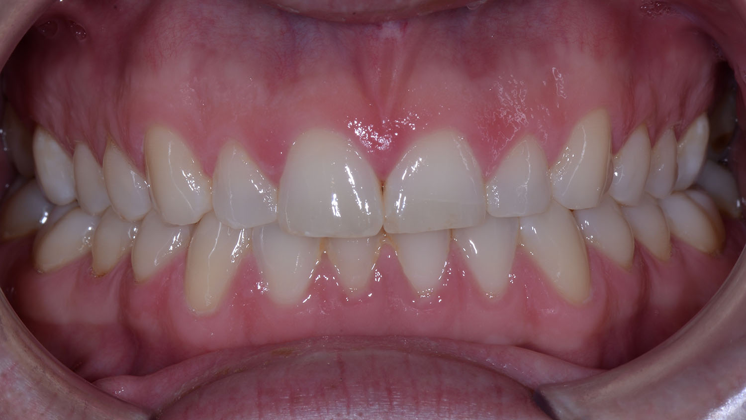 What is Lock Jaw? Can You Treat It at Home?