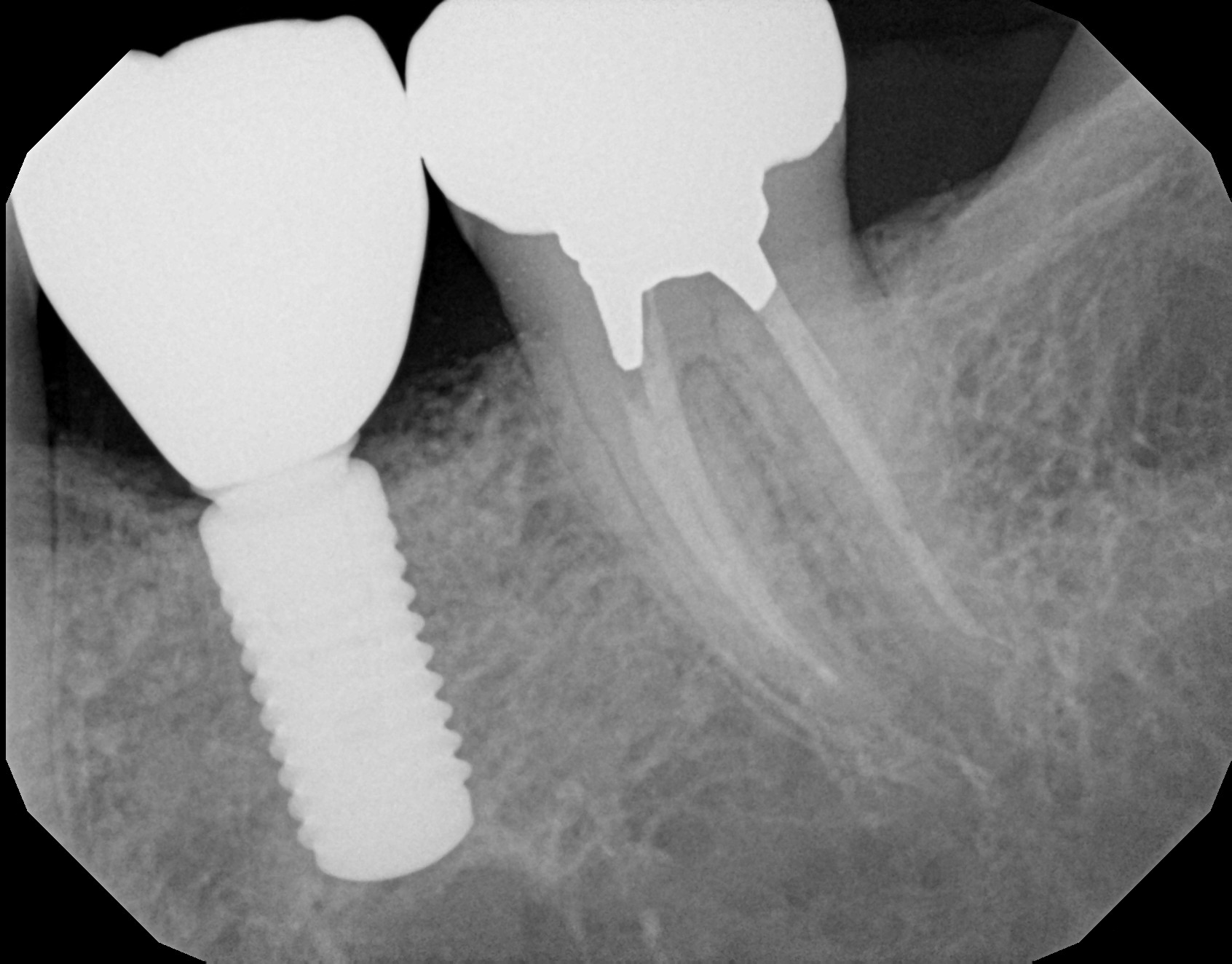 Treatment Options To Close A Gap Between The Front Teeth