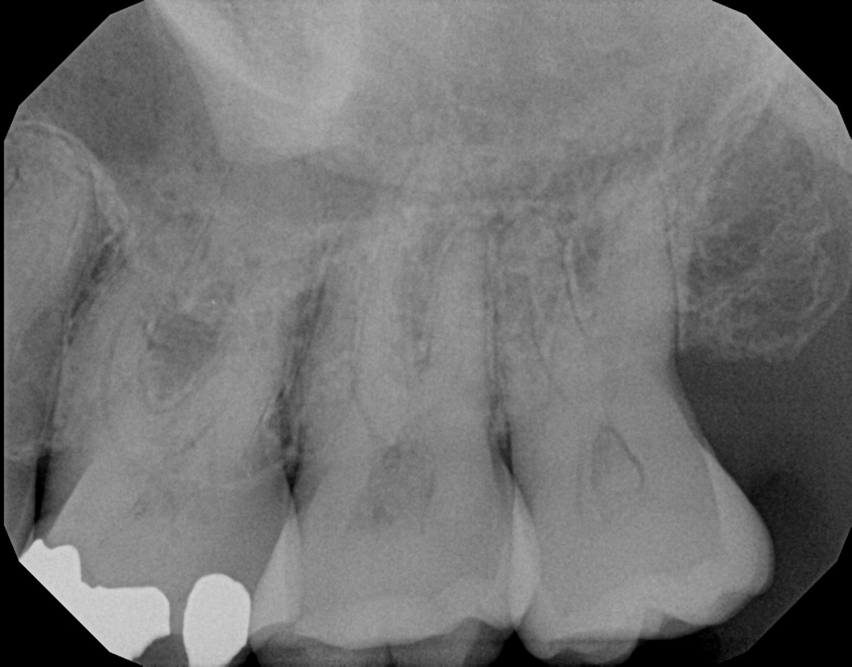 What You Need to Do Right After Tooth Extractions