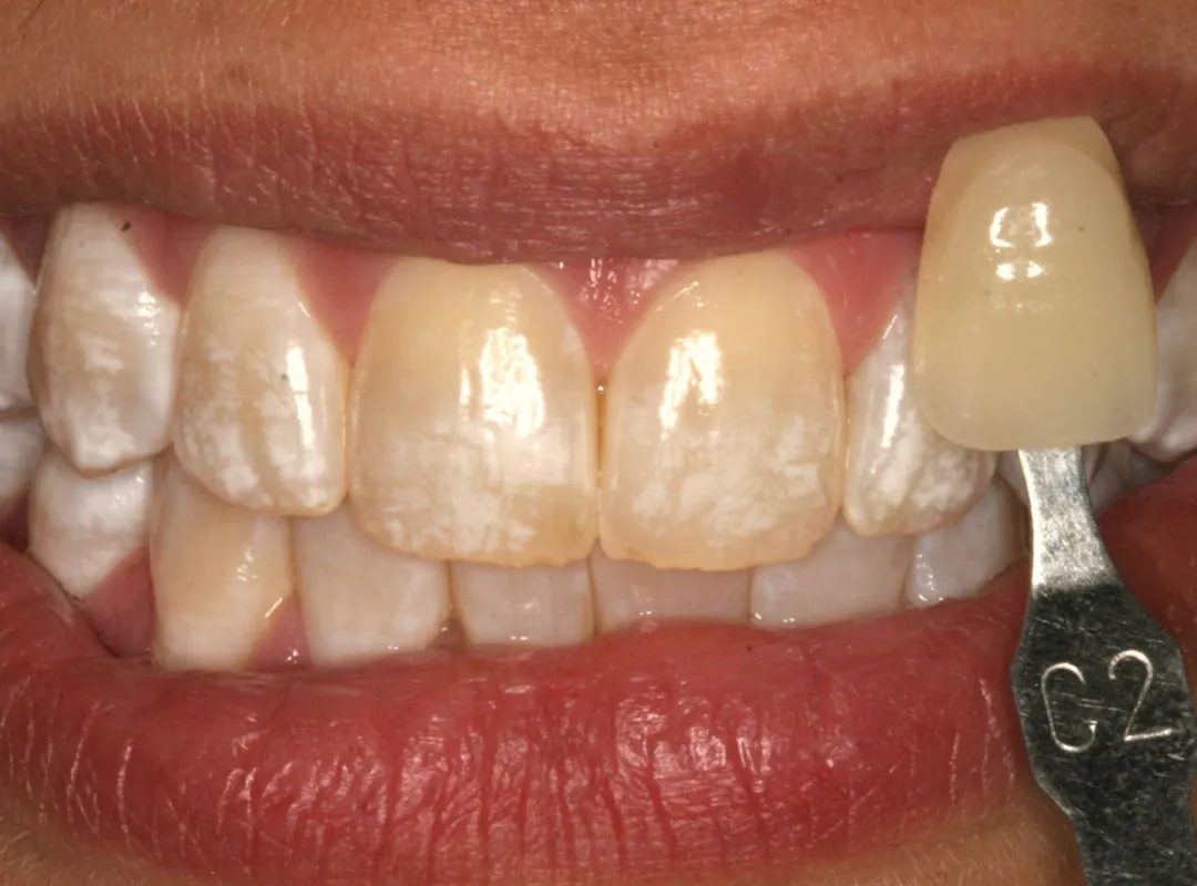 Expert Distal Wedge Procedure in Garden Grove | Perfect Smile Dental Care