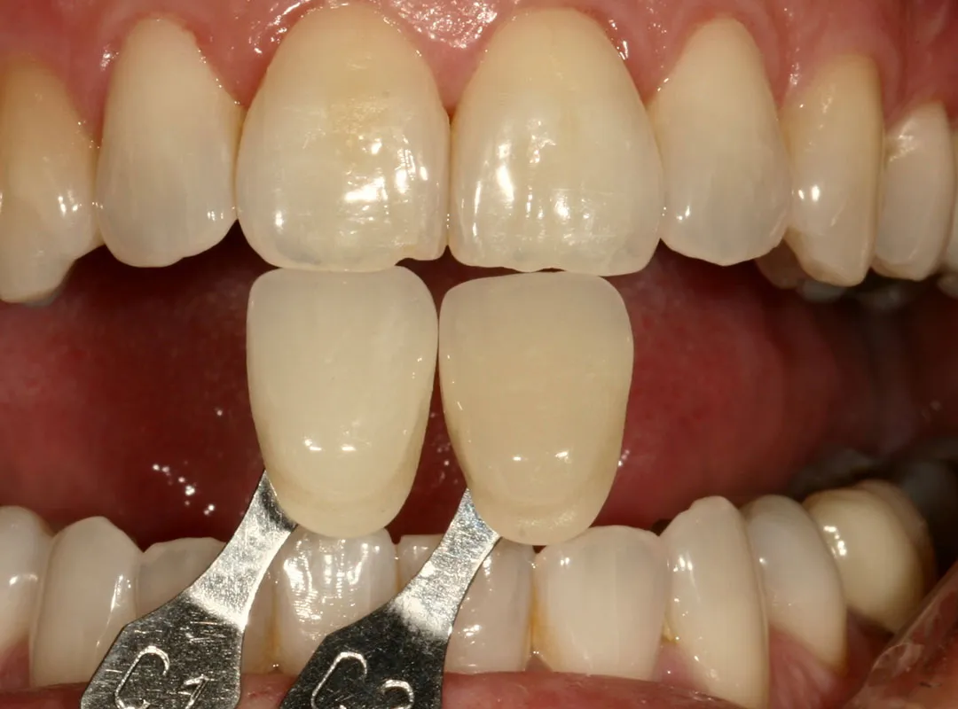Expert Distal Wedge Procedure in Garden Grove | Perfect Smile Dental Care