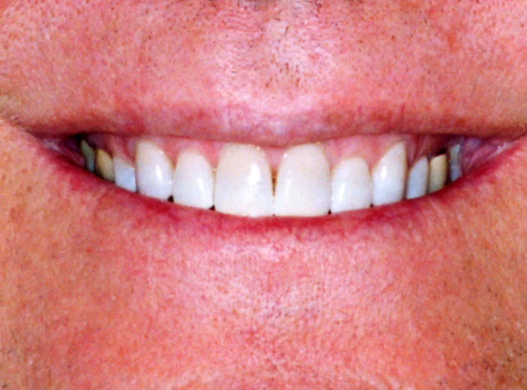 Expert Distal Wedge Procedure in Garden Grove | Perfect Smile Dental Care