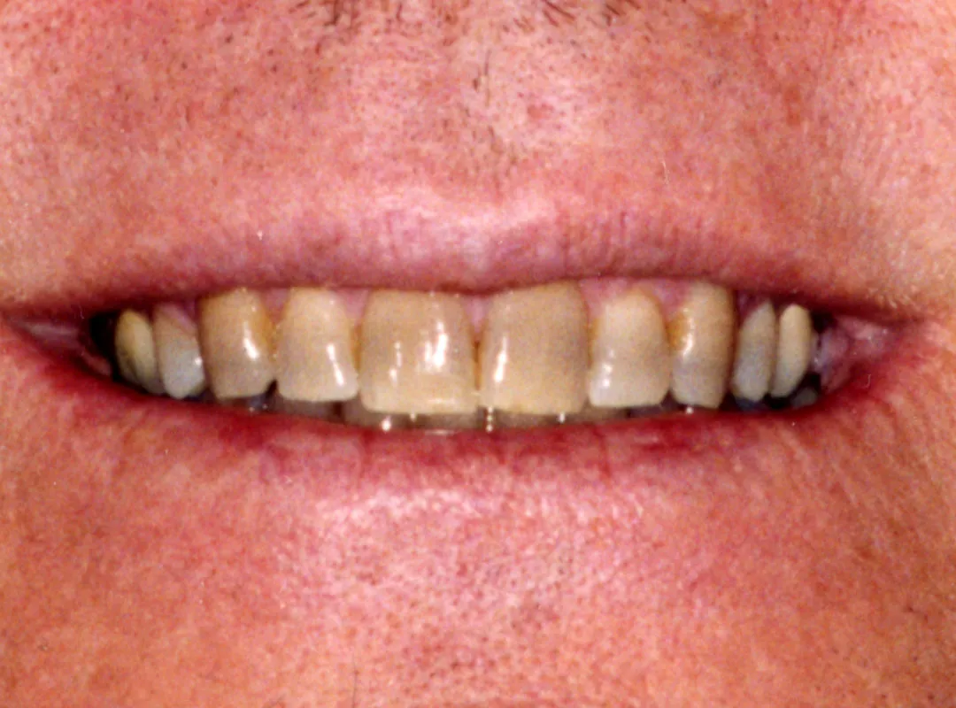 Expert Distal Wedge Procedure in Garden Grove | Perfect Smile Dental Care