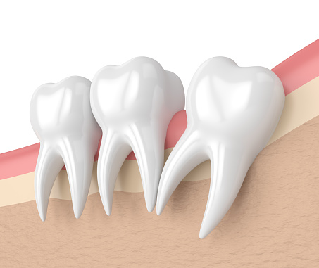 Expert Distal Wedge Procedure in Garden Grove | Perfect Smile Dental Care