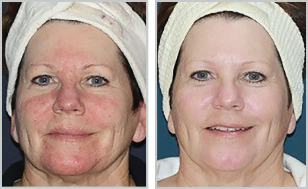 Forever Young BBL |Tyte Medispa Millbrook,NY