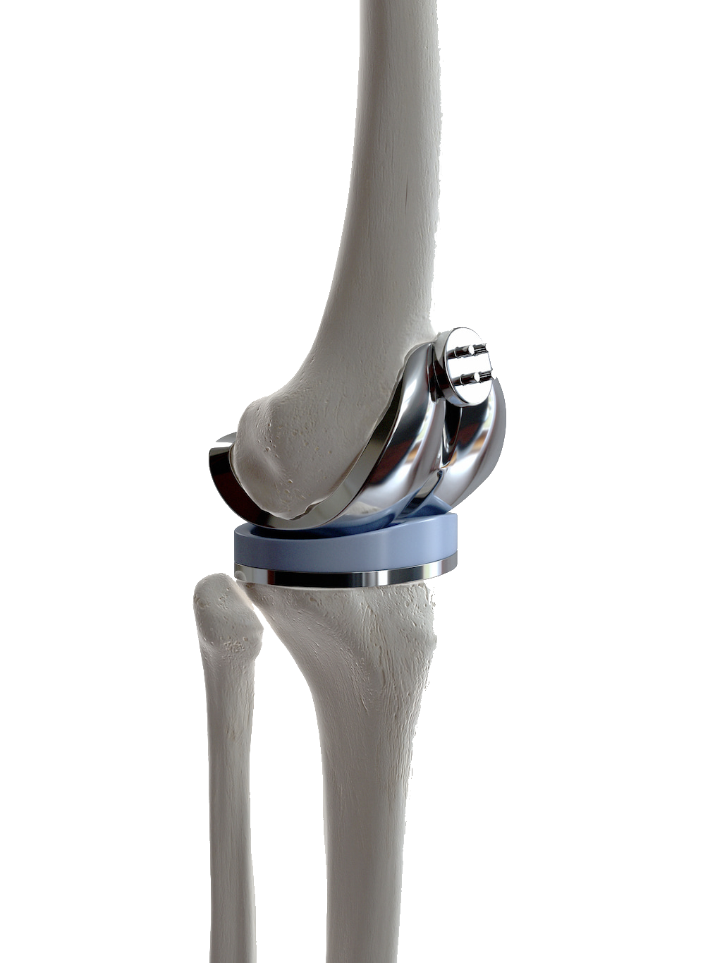 Above Knee Prosthetic Leg in New Mexico | PrimeCare Orthotics & Prosthetics