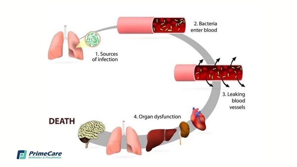 Sepsis: síntomas, tratamiento, amputación | Primecare Orthotics ...