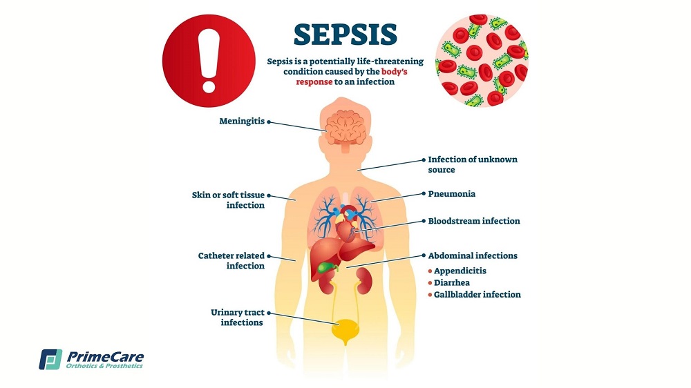 Sepsis: síntomas, tratamiento, amputación | Primecare Orthotics & Prosthetics