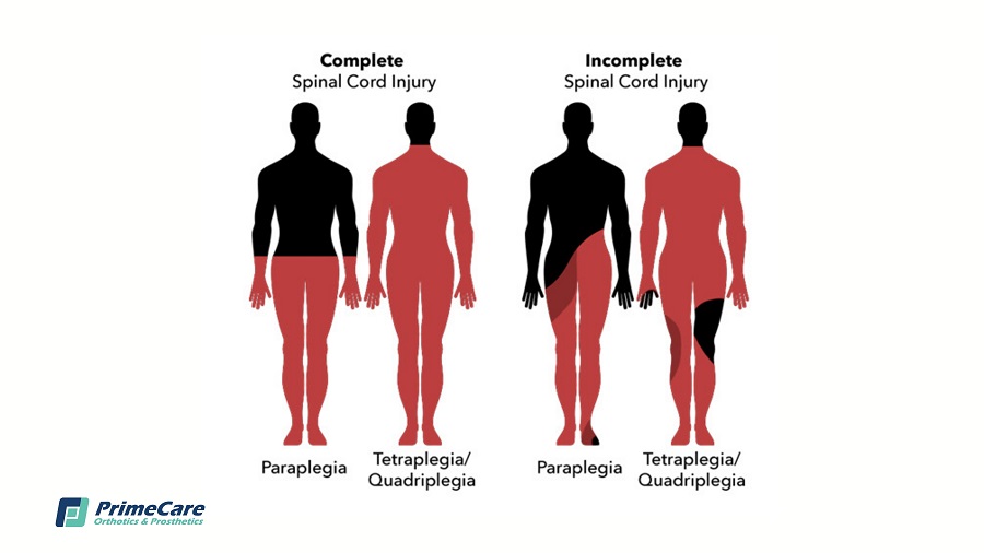 Lesión medular: Síntomas, causas, riesgos | PrimeCare Orthotics ...