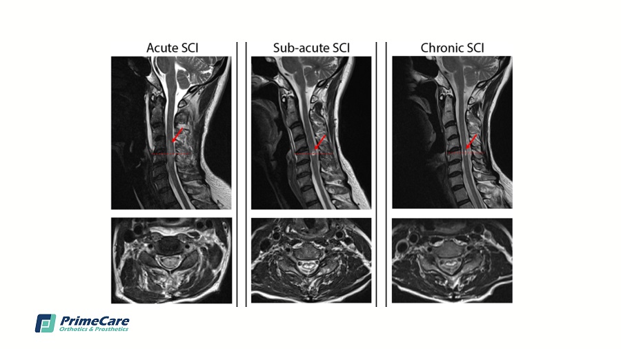 Lesión medular: Síntomas, causas, riesgos | PrimeCare Orthotics ...