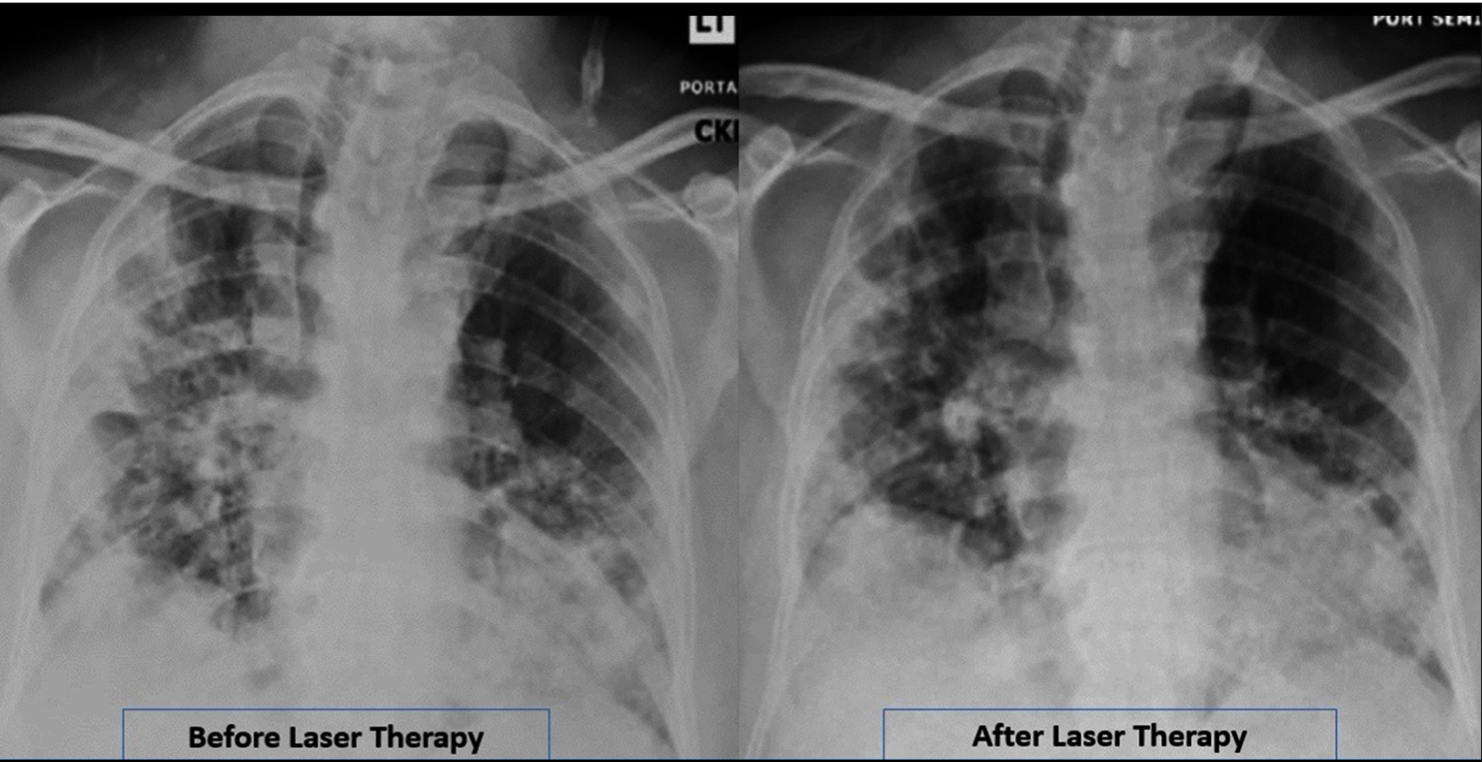 Sinus Infections & Low-level Laser Therapy - Kaiyan Medical
