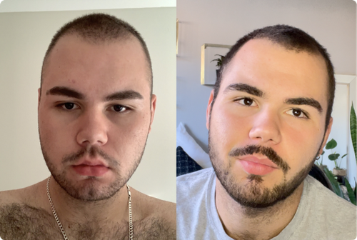 Pilot vs Mosh Hair Loss Treatment