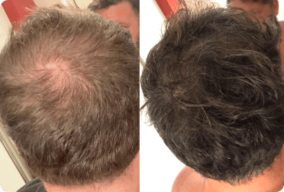 Pilot vs Mosh Hair Loss Treatment