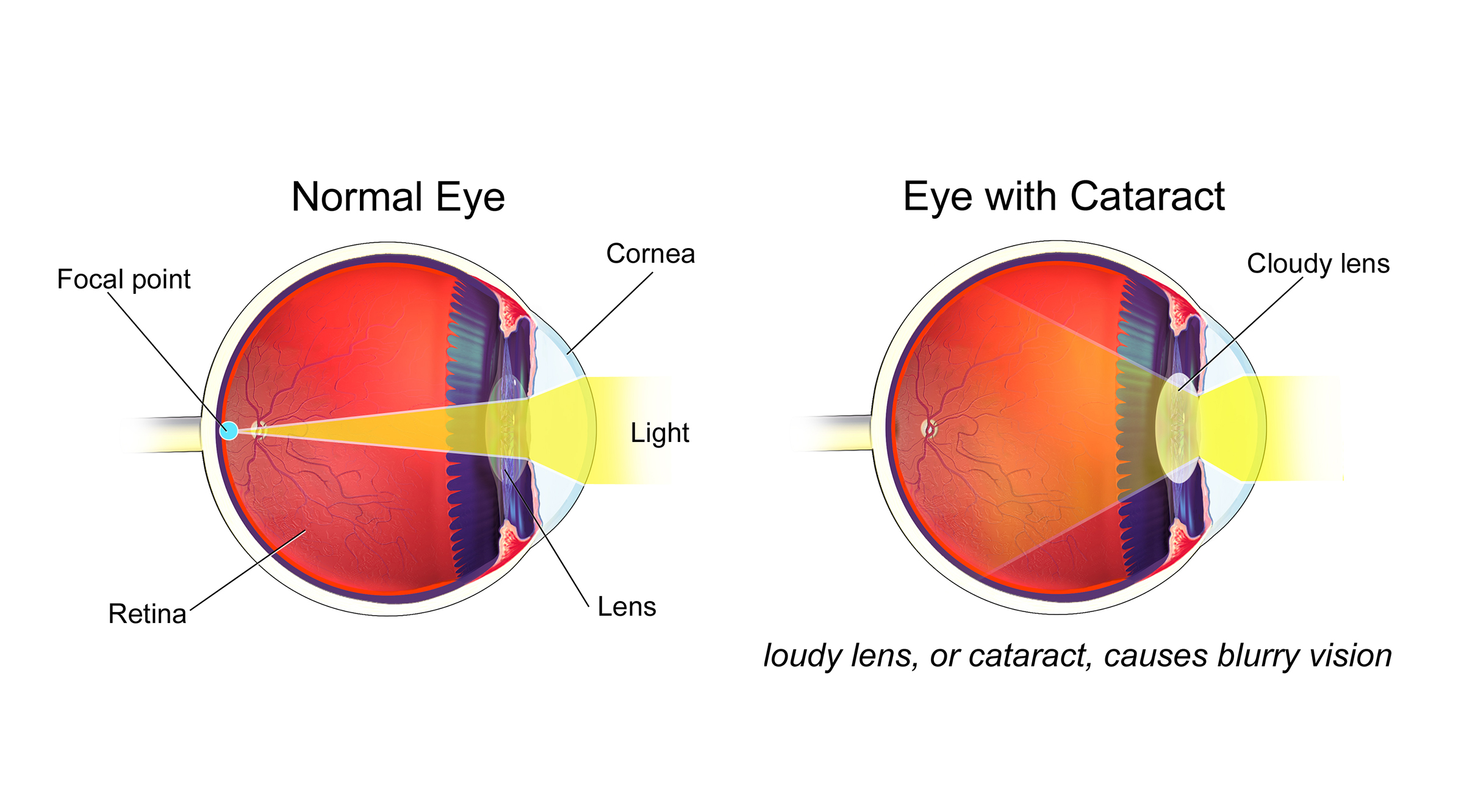 Cataract Awareness | Punzal Vision