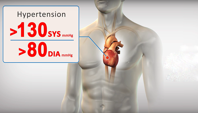 Orchestra BioMed’s BackBeat Cardiac Neuromodulation Therapy Gets CE ...