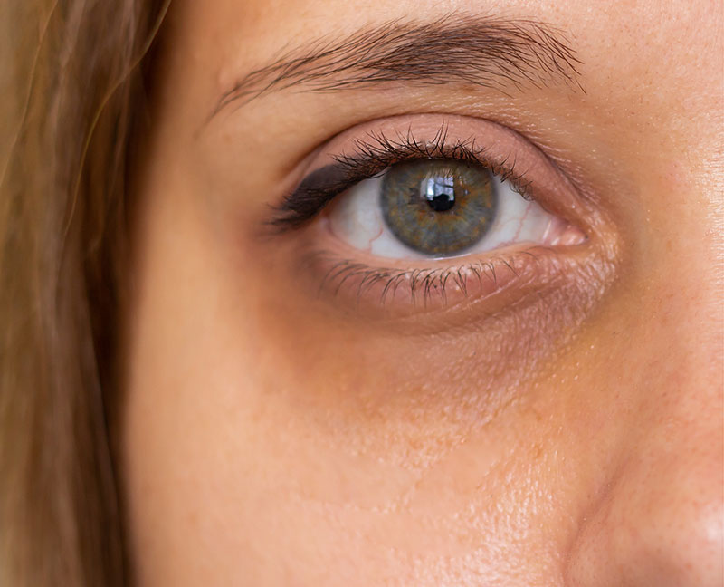 ¿Cómo podemos tratar las ojeras desde la medicina estética? | Dra. Ruiz