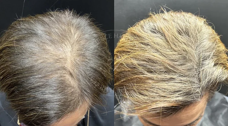 ArtiScience Hair | Singapore Hair Loss Treatments