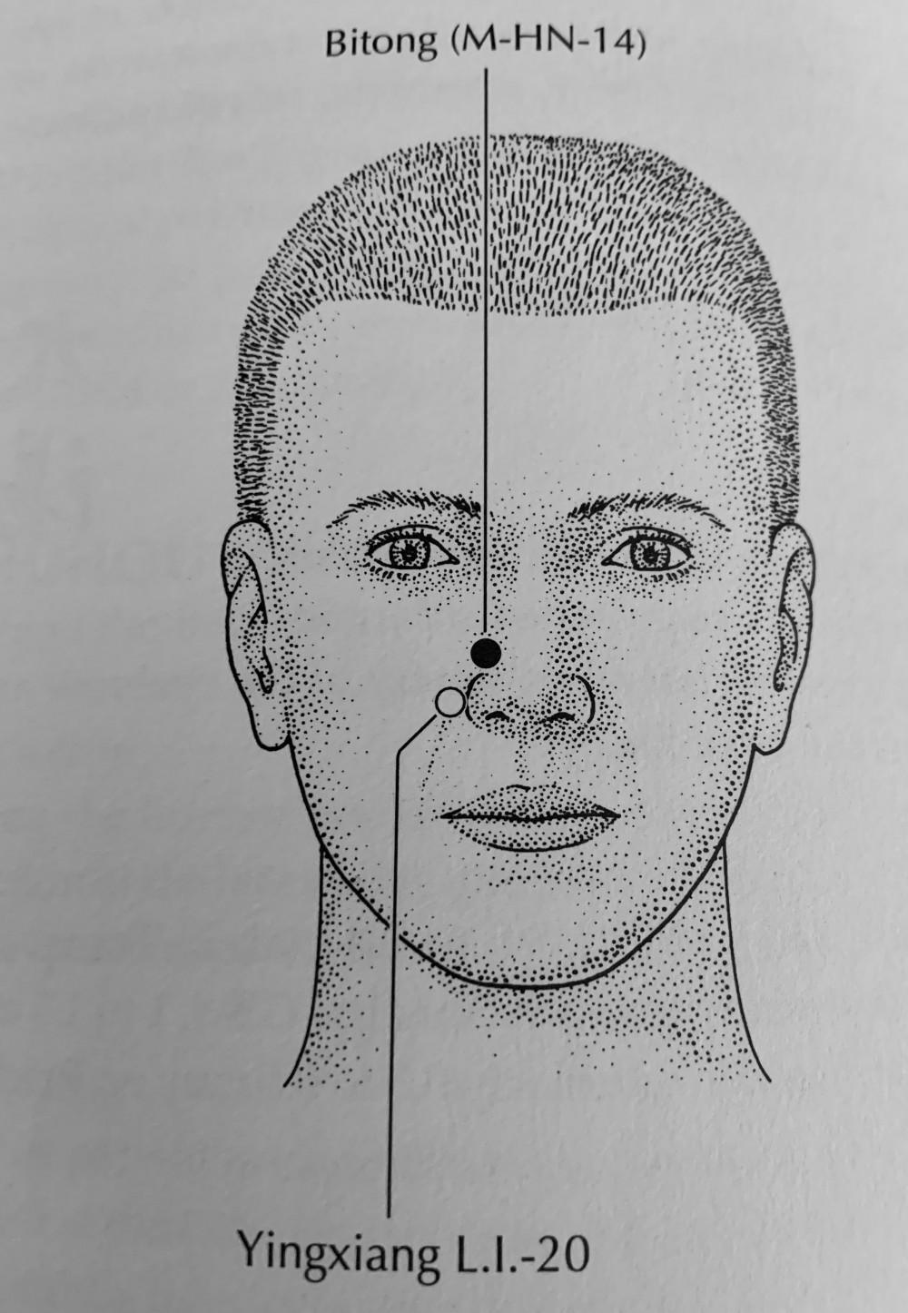 Some relief from Rhinitis How to Get Rid of Fluid in the Ear from a ...