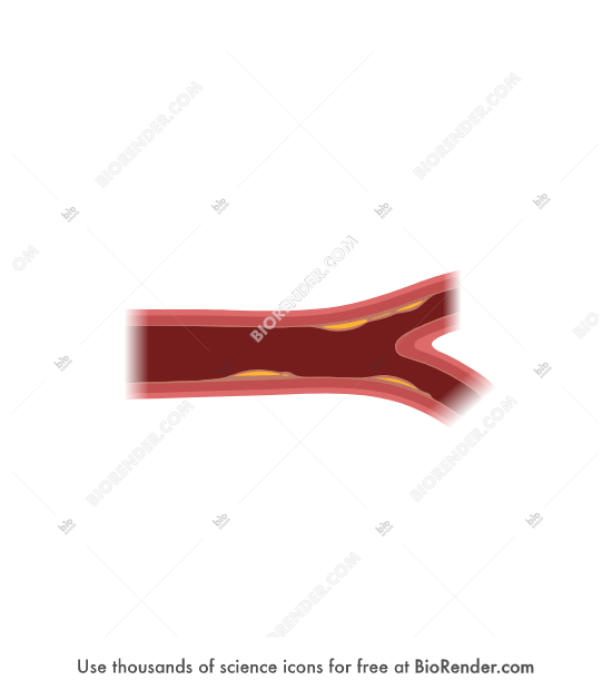 Free Atherosclerosis (1a. fatty streak) Icons, Symbols & Images | BioRender