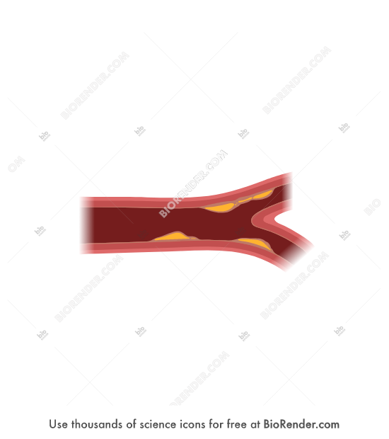Free Atherosclerosis (1b. Intermediate lesion) Icons, Symbols & Images ...