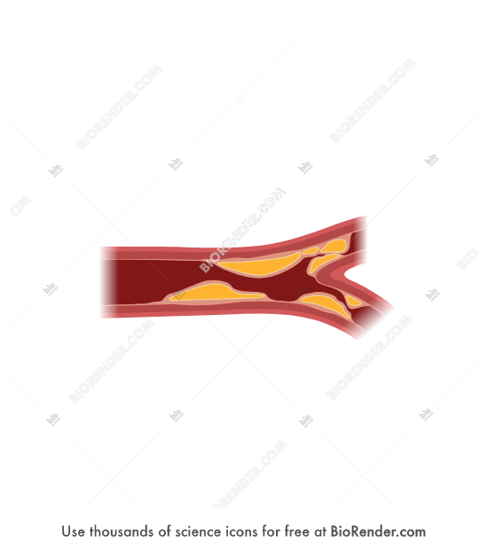 Free Atherosclerosis (2. fibrous plaque) Icons, Symbols & Images ...