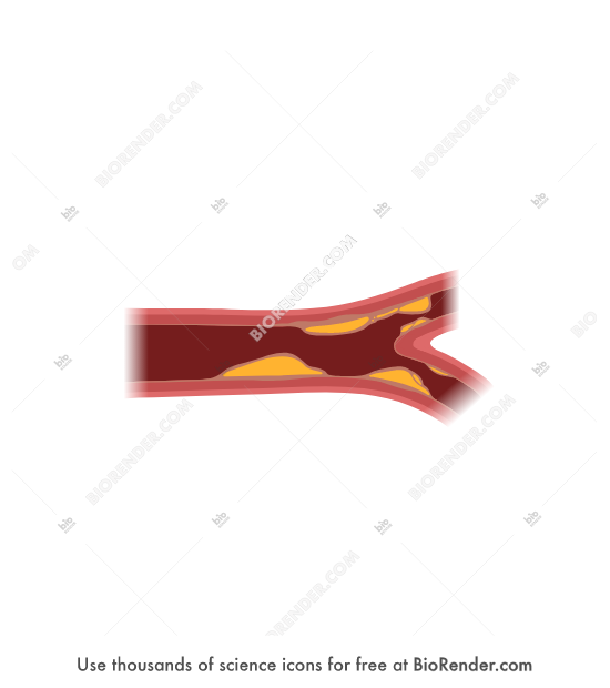 Free Atherosclerosis (1c. atheroma) Icons, Symbols & Images | BioRender